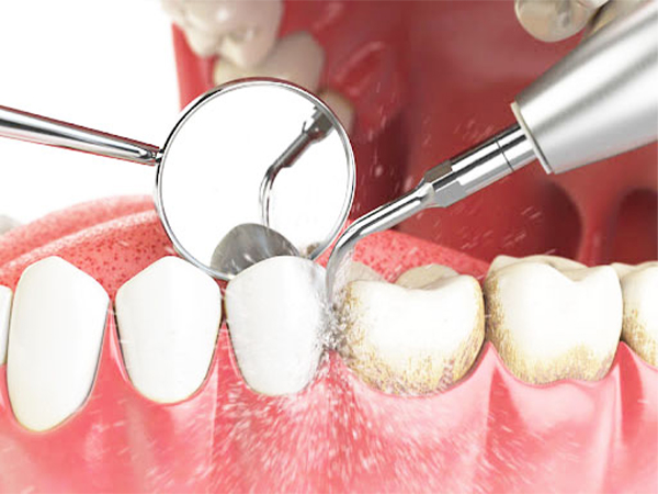 Dental Scaling and Airflow Polishing - Al Malaki Specialist Hospital ...